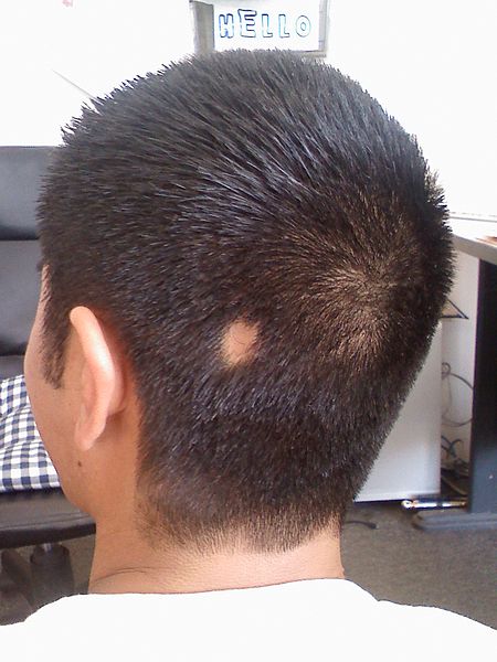 Alopecia Areata - Causes, Types, Symptoms & Treatment - SkinPractice